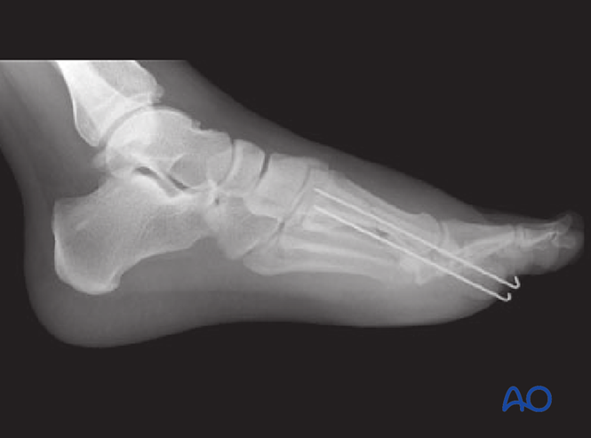 Intramedullary K-wire fixation for Simple diaphyseal and proximal ...