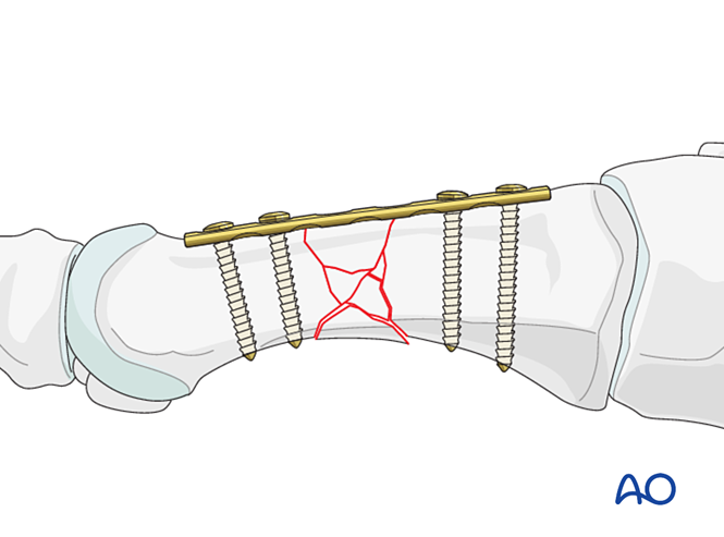 Bridge plate fixation for Multifragmentary diaphyseal and proximal ...