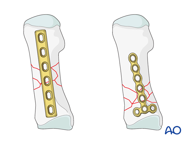 Bridge plate fixation for Multifragmentary diaphyseal and proximal ...