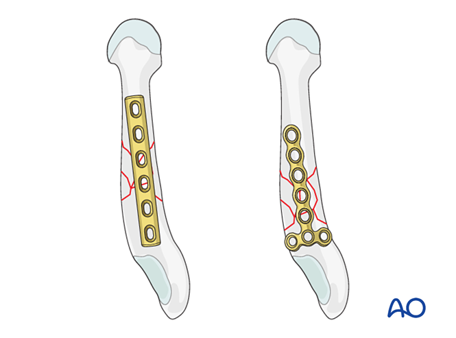 Bridge plate fixation for Diaphyseal fractures of the 5th metatarsal