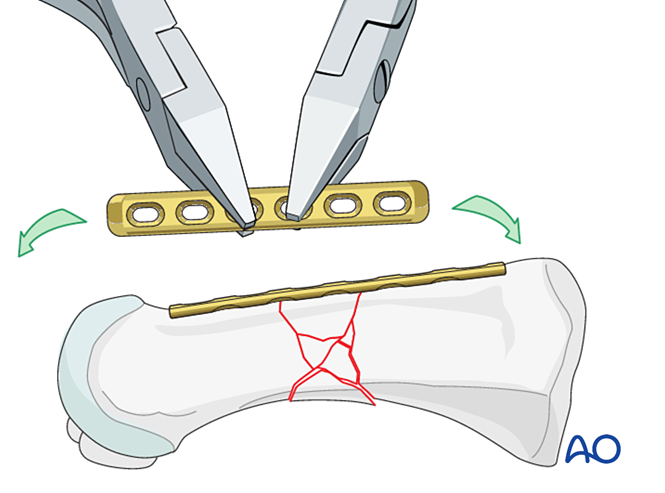 Bridge plate fixation for Multifragmentary diaphyseal and proximal ...