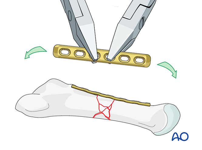 Bridge plate fixation for Diaphyseal fractures of the 5th metatarsal