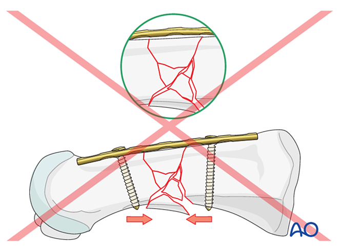 Bridge plate fixation for Multifragmentary diaphyseal and proximal ...
