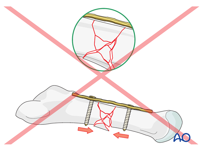 Bridge plate fixation for Diaphyseal fractures of the 5th metatarsal