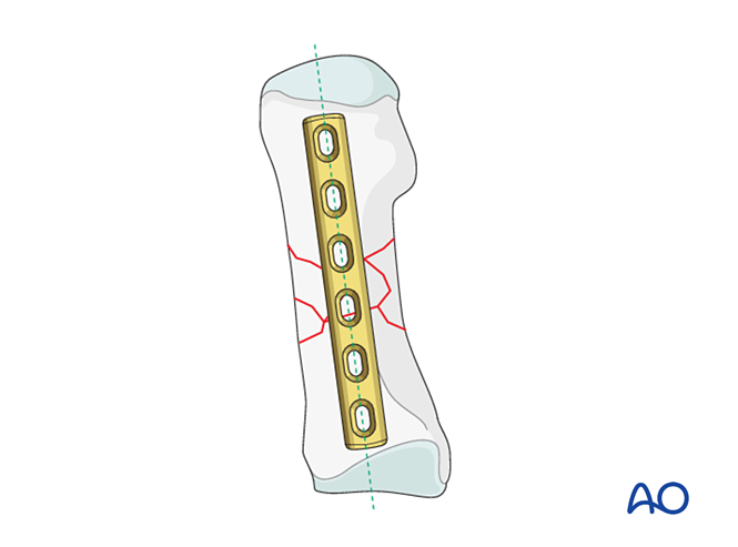Bridge plate fixation for Multifragmentary diaphyseal and proximal ...