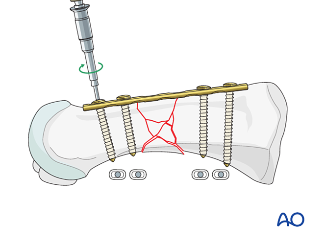 Bridge plate fixation for Multifragmentary diaphyseal and proximal ...