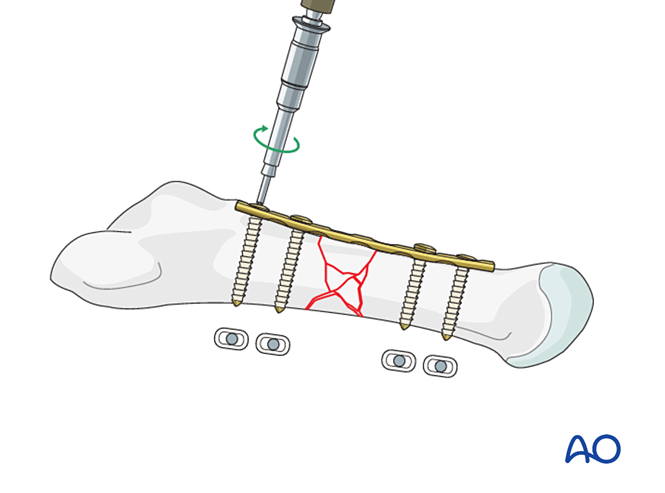 Bridge plate fixation for Diaphyseal fractures of the 5th metatarsal