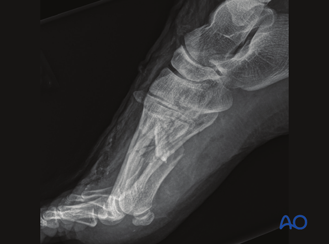 Bridge plate fixation for Multifragmentary diaphyseal and proximal ...