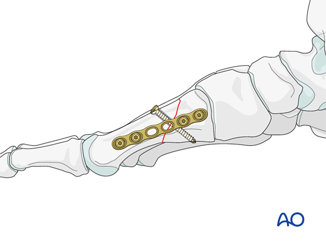 Lag screw and neutralization plate for Simple diaphyseal and proximal ...