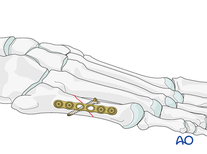 Lag screw and neutralization plate for Diaphyseal fractures of the 5th ...