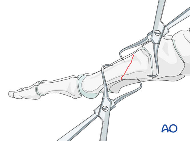 Lag screw and neutralization plate for Simple diaphyseal and proximal ...