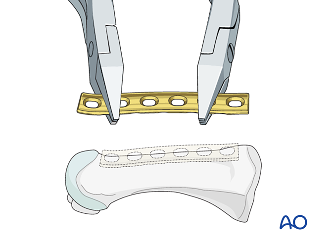 Lag screw and neutralization plate for Wedge diaphyseal and proximal ...
