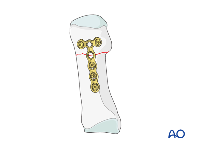 T-plate fixation with compression for Distal extraarticular fractures ...