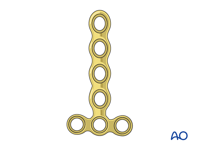 T-plate fixation with compression for Simple diaphyseal and proximal ...