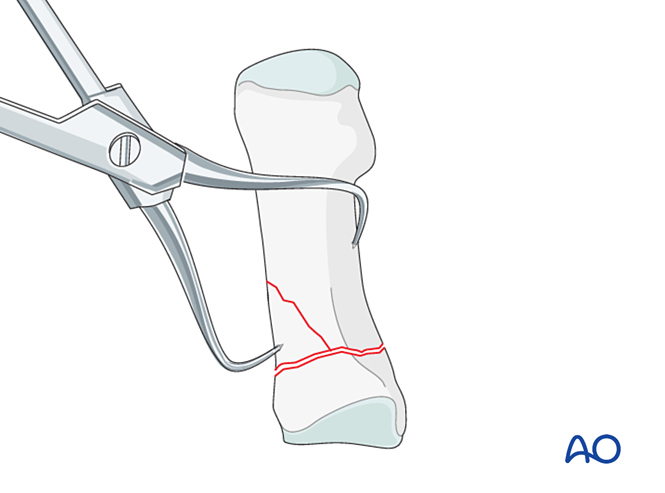 T-plate fixation with compression for Wedge diaphyseal and proximal ...