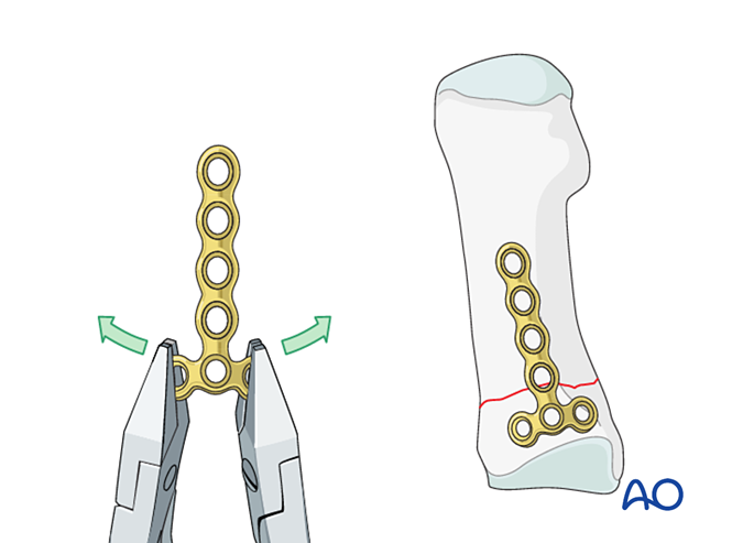 T-plate fixation with compression for Simple diaphyseal and proximal ...