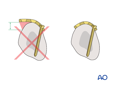 T-plate fixation with compression for Simple diaphyseal and proximal ...