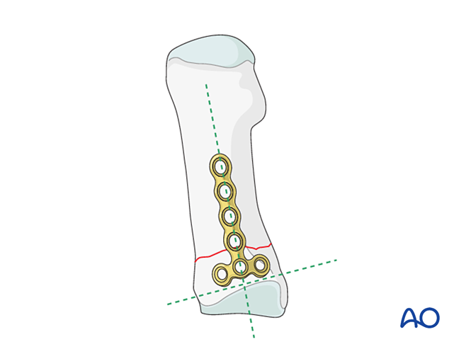 T-plate fixation with compression for Simple diaphyseal and proximal ...