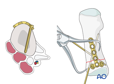 T-plate fixation with compression for Simple diaphyseal and proximal ...