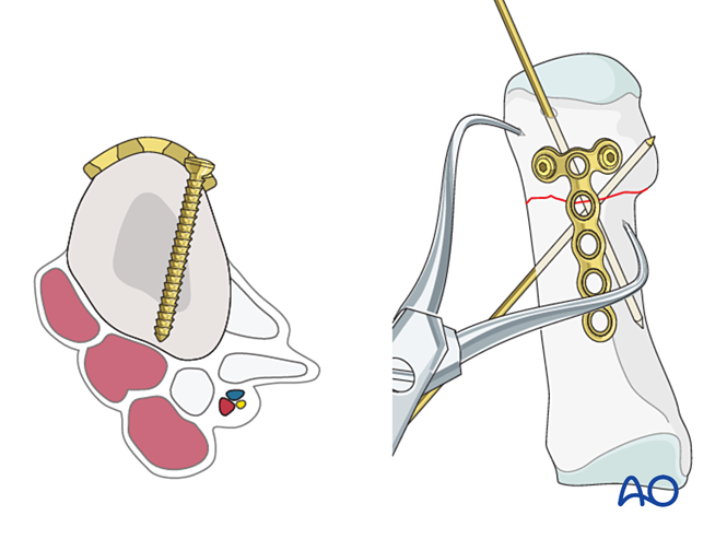 T-plate fixation with compression for Distal extraarticular fractures ...