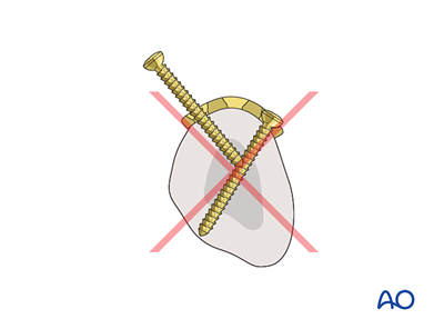 T-plate fixation with compression for Simple diaphyseal and proximal ...