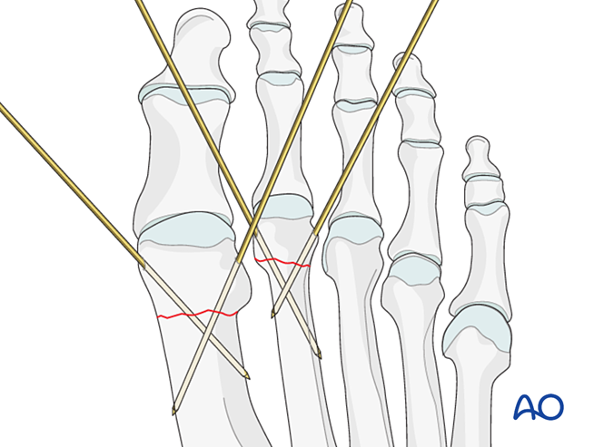 K-wire fixation for Distal extraarticular fractures of the 1st to 4th ...