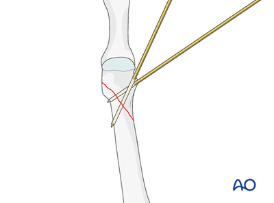 K-wire fixation for Distal extraarticular fractures of the 1st to 4th ...