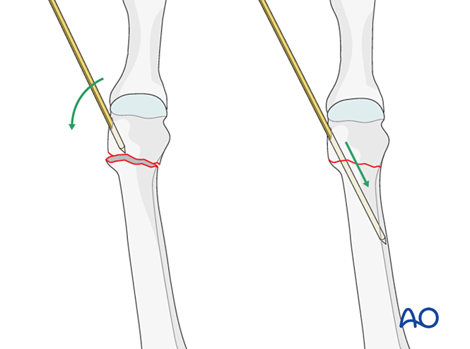 K Wire Fixation For Distal Extraarticular Fractures Of The 1st To 4th