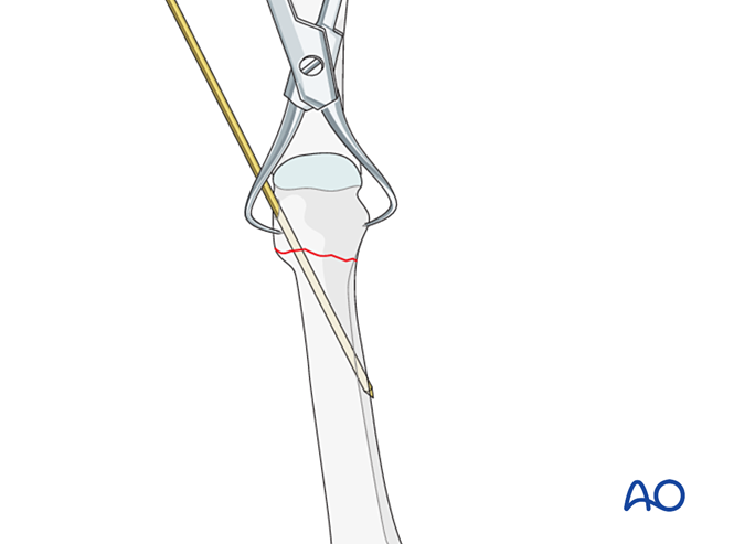 K-wire fixation for Distal extraarticular fractures of the 1st to 4th ...