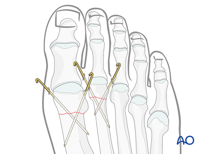K-wire fixation for Distal extraarticular fractures of the 1st to 4th ...