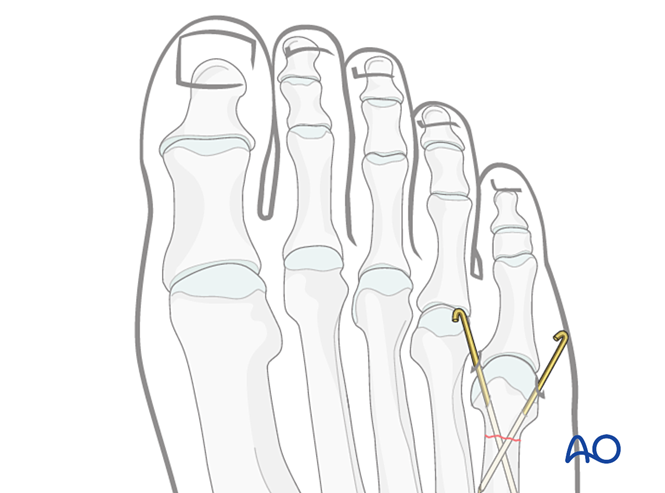 K-wire fixation for Distal fractures of the 5th metatarsal