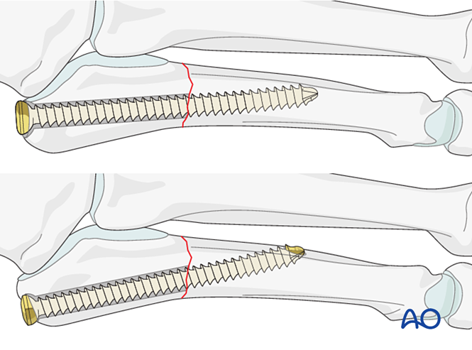 Intramedullary screw or lag screw fixation for Proximal extraarticular fractures of the 5th ...