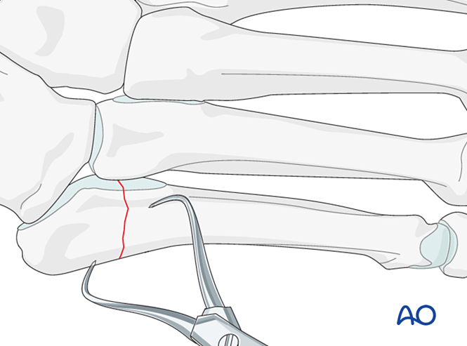 Intramedullary screw or lag screw fixation for Proximal articular ...