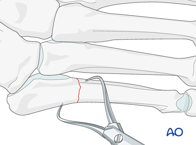 Intramedullary screw or lag screw fixation for Proximal extraarticular ...