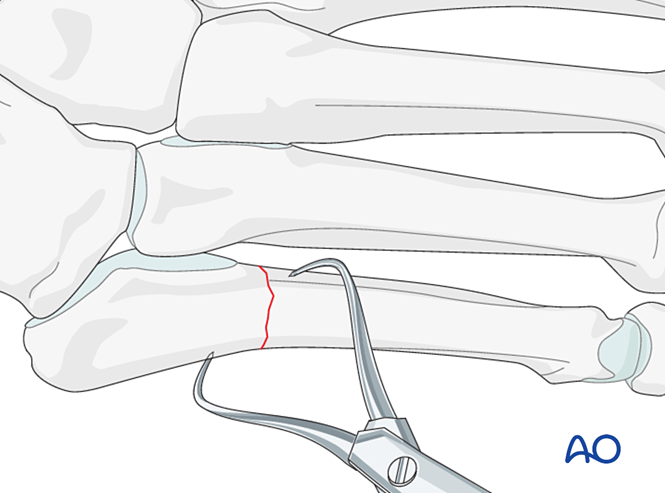 Intramedullary screw or lag screw fixation for Proximal extraarticular ...