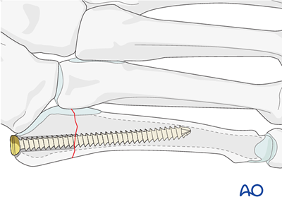 Intramedullary screw or lag screw fixation for Proximal articular ...
