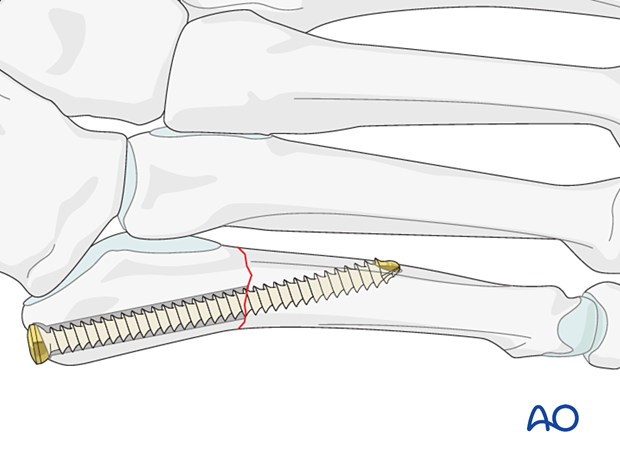 Styloid Process Of 5th Metatarsal