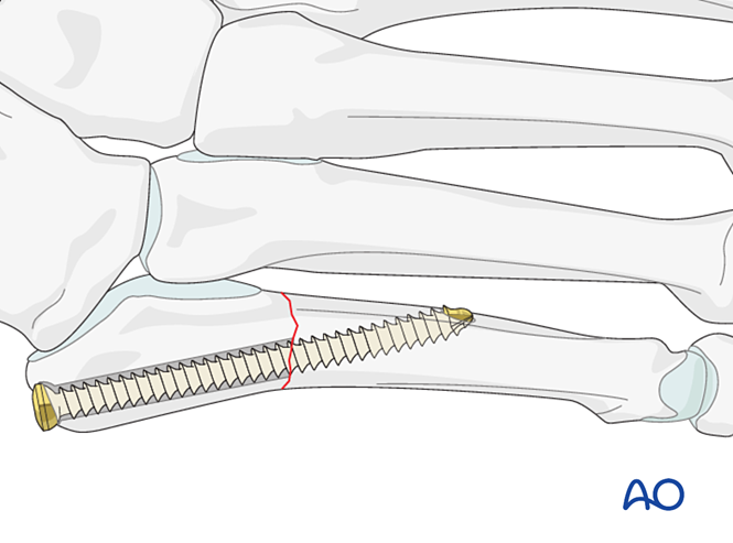 Intramedullary screw or lag screw fixation for Proximal extraarticular ...