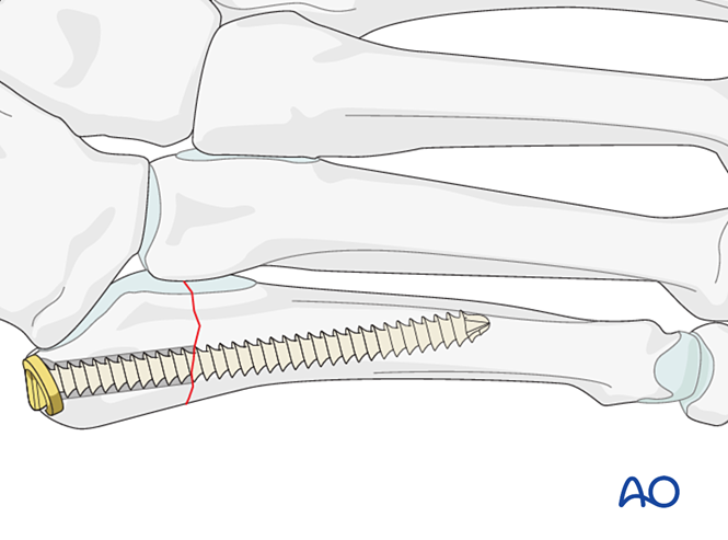 Intramedullary screw or lag screw fixation for Proximal articular ...