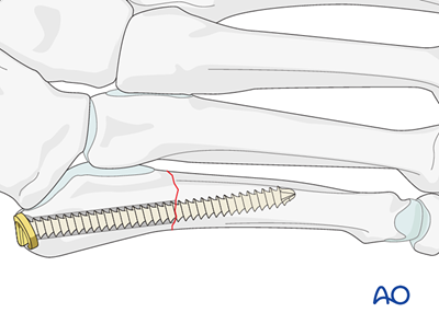 Intramedullary screw or lag screw fixation for Proximal extraarticular ...