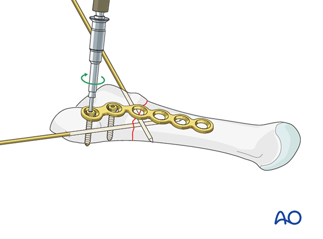 Plate fixation for Proximal extraarticular fractures of the 5th ...