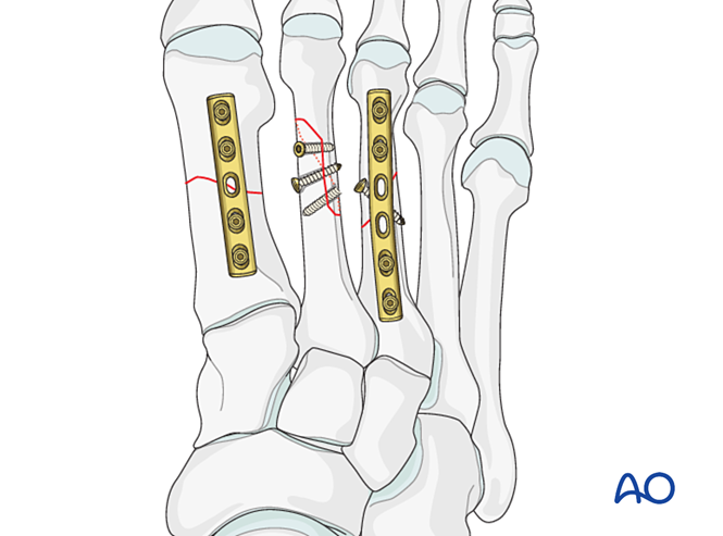 ORIF for Crush injuries