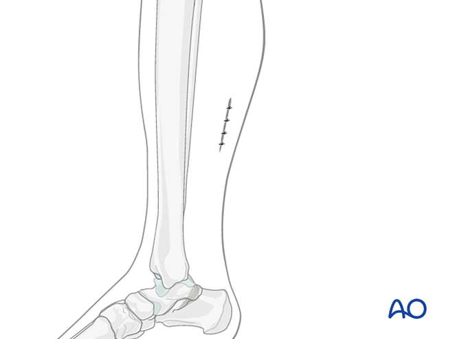 Release of the gastrocnemius equinus