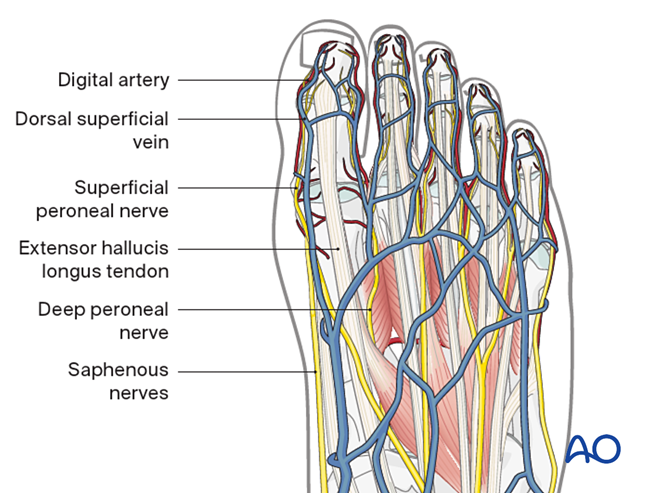 Dorsal approach to the 1st metatarsal phalangeal joint (MTPJ)