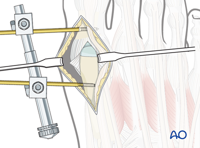 Dorsal approach to the 1st metatarsal phalangeal joint (MTPJ)