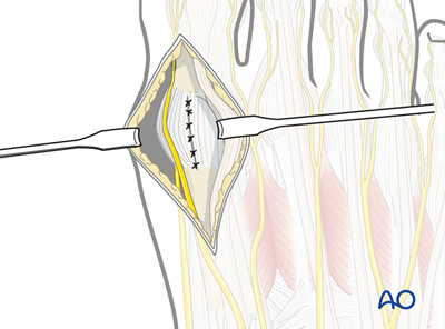 Dorsal approach to the first metatarsal phalangeal joint (MTPJ)