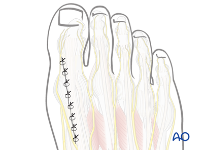 Dorsal approach to the 1st metatarsal phalangeal joint (MTPJ)