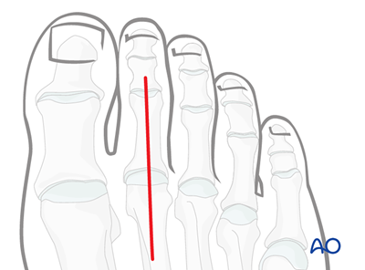 K-wire fixation for Lesser toe fractures