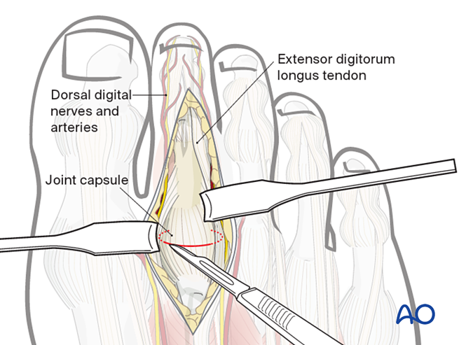 Dorsal approach to the proximal phalanx