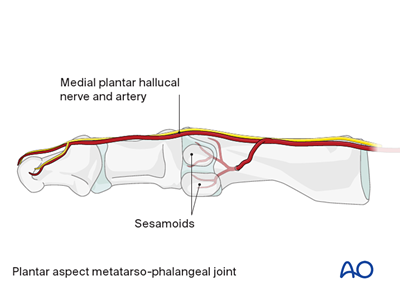 Medial approach to the hallux